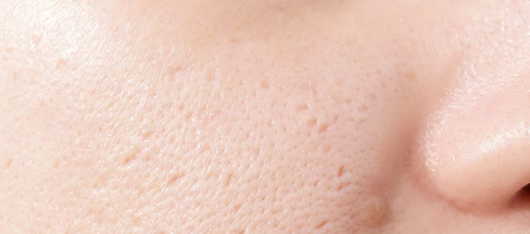 Comment enlever les trous sur le visage ? | Centre Trémoille | Paris 8